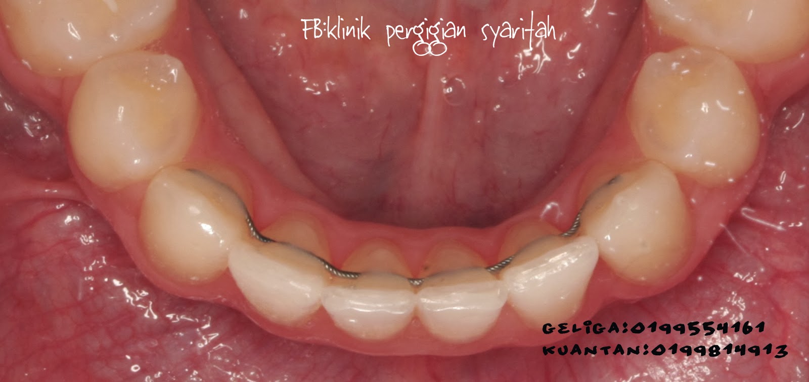 KLINIK PERGIGIAN SYARIFAH: PEMAKAIAN RETAINER ADALAH WAJIB