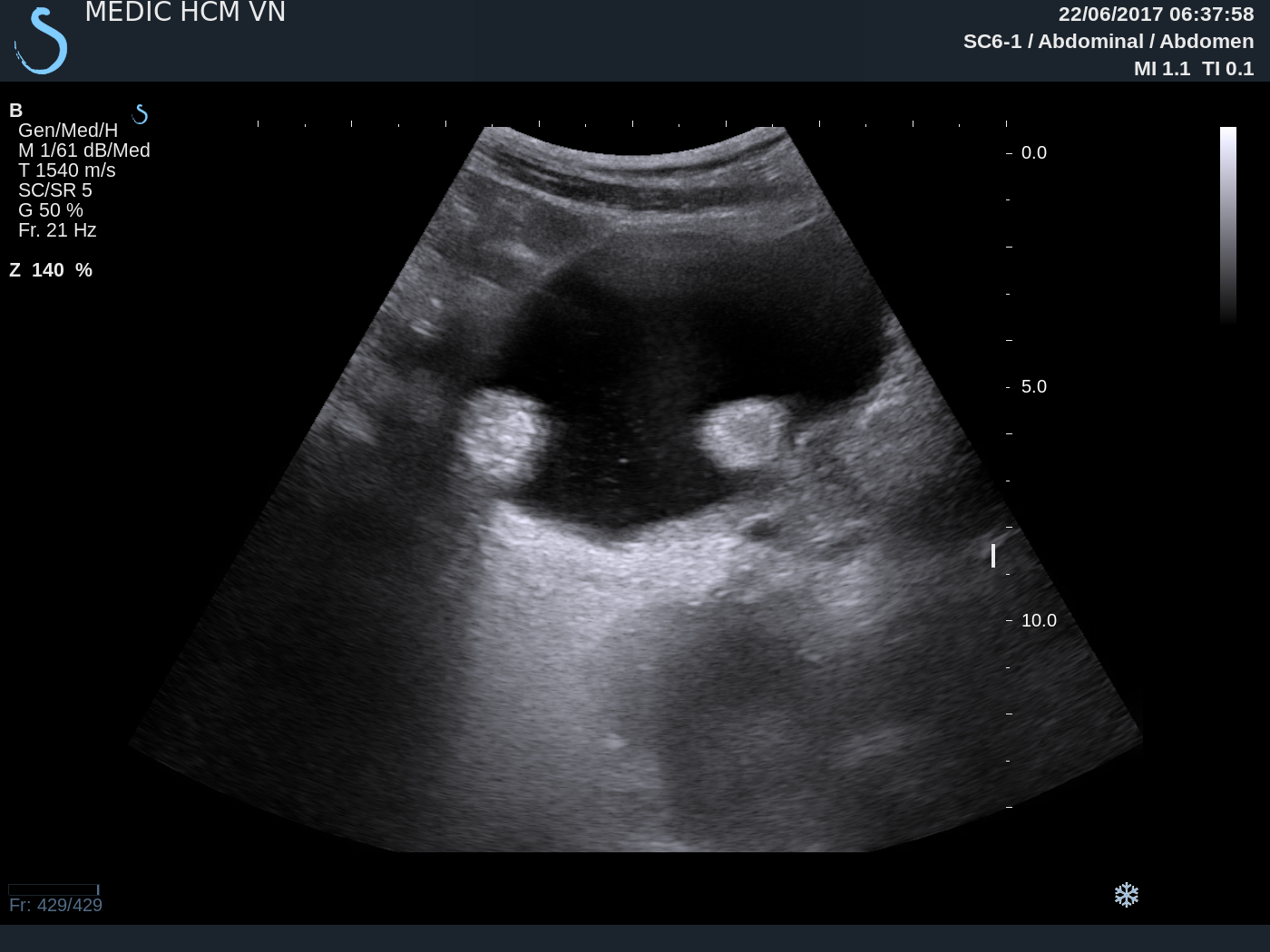 Kuttner Tumor