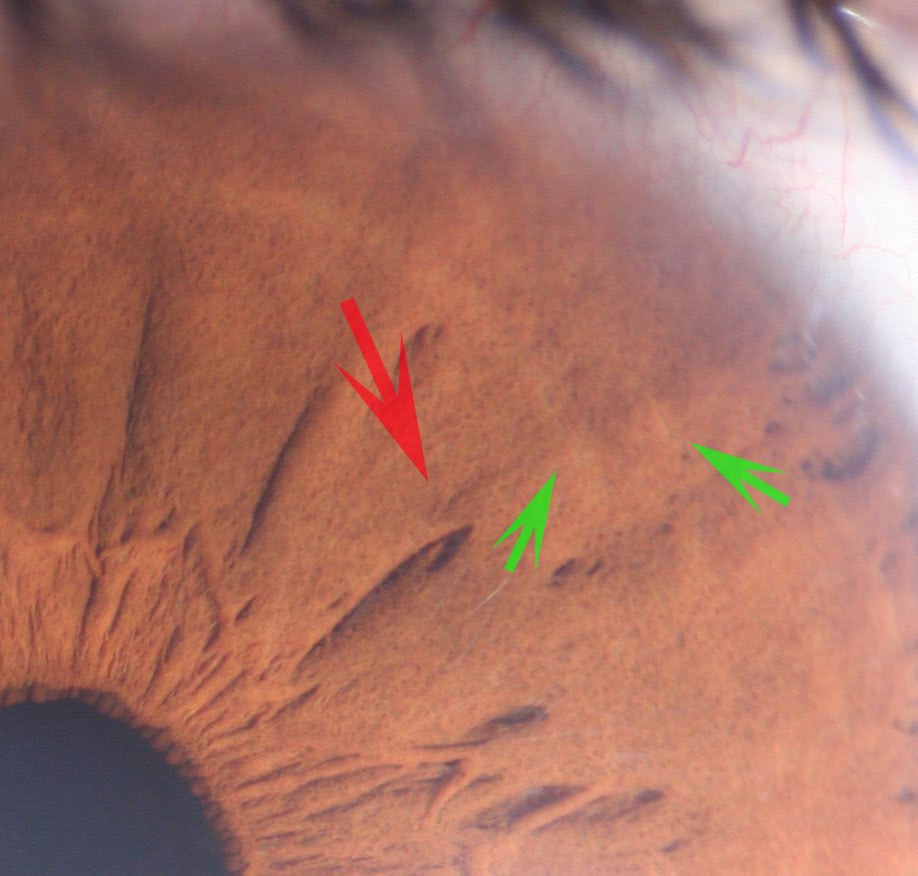 Modern & Multidimensional Iridology: Radial Furrow Co-sign with Stress ...