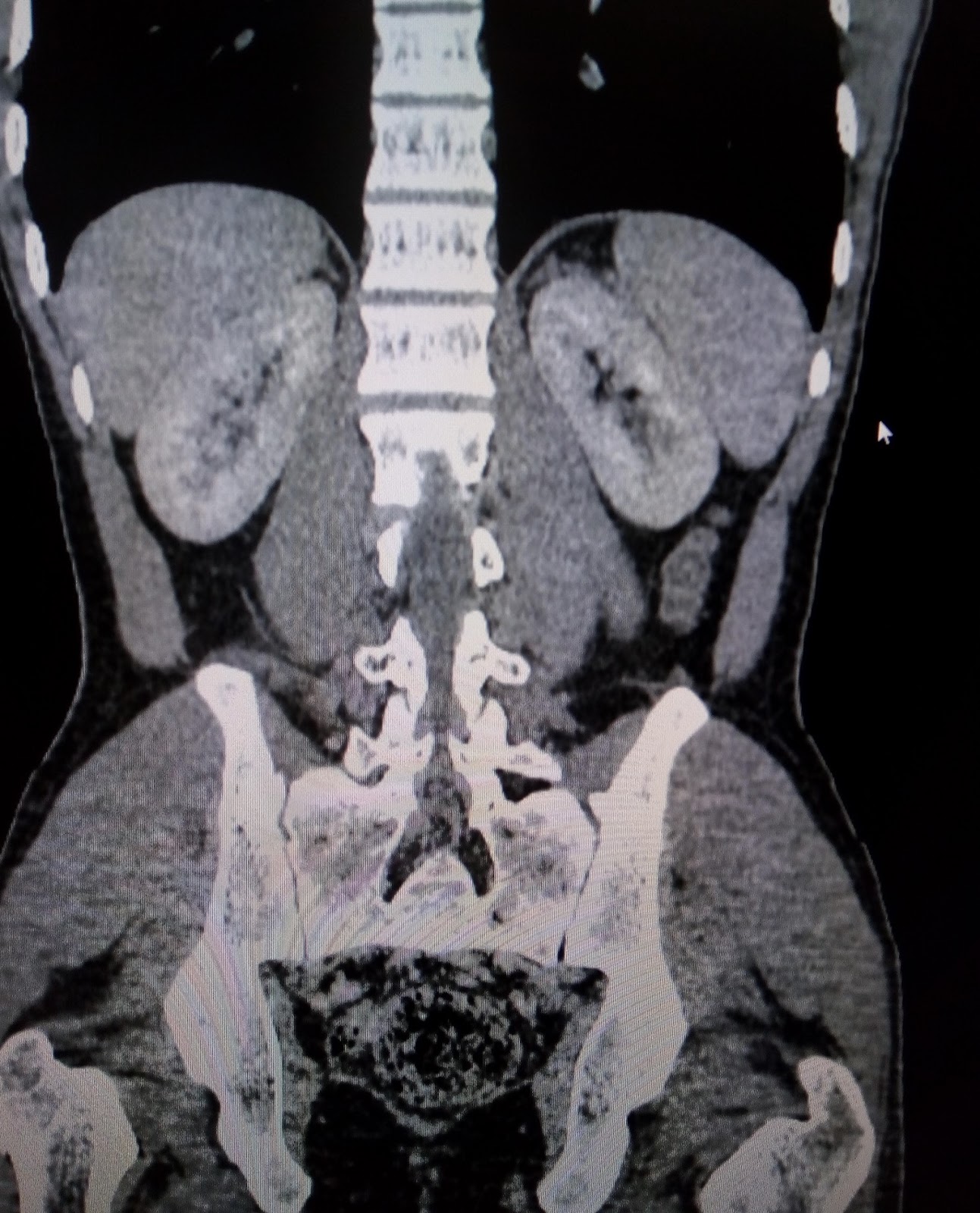 Bladder exstrophy – CT - Sumer's Radiology Blog