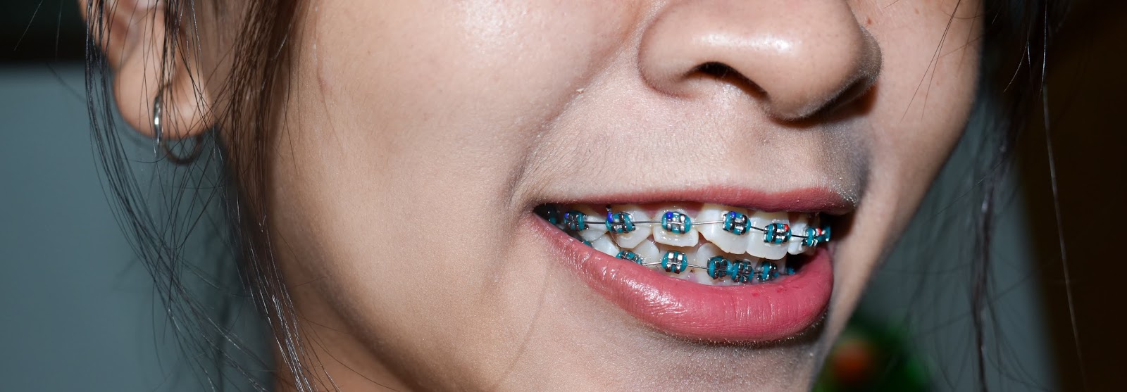 My Braces Journey: Part II (Pasang Behel di FDC - Tahap-Tahap ...