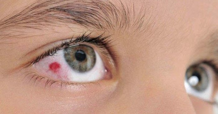 TU SALUD Y LA NUTRICIÓN.: HEMORRAGIAS OCULARES. ¿Cuales son las causas?