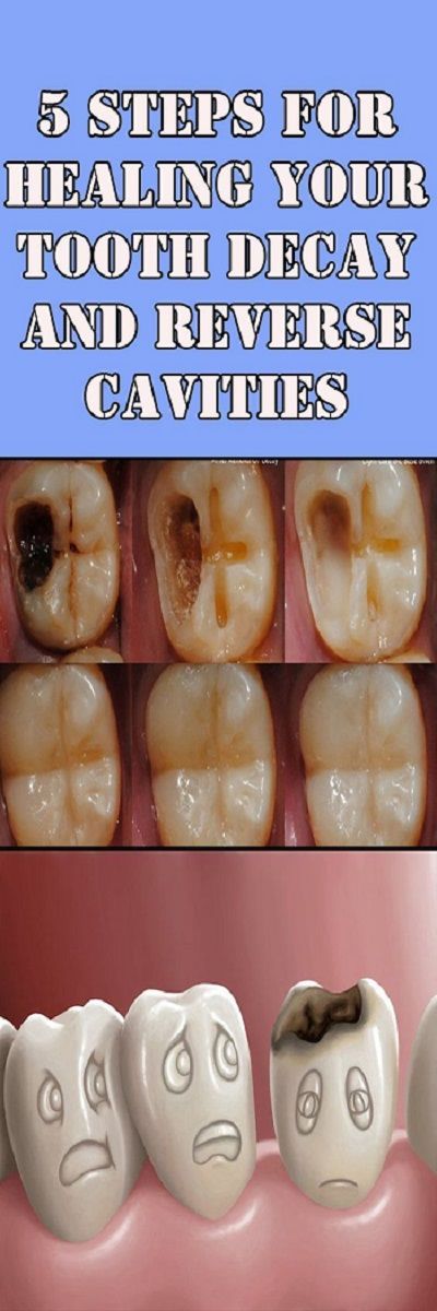 5 TIPS ON HOW TO REVERSE CAVITIES AND HEAL TOOTH DECAY NATURALLY ...