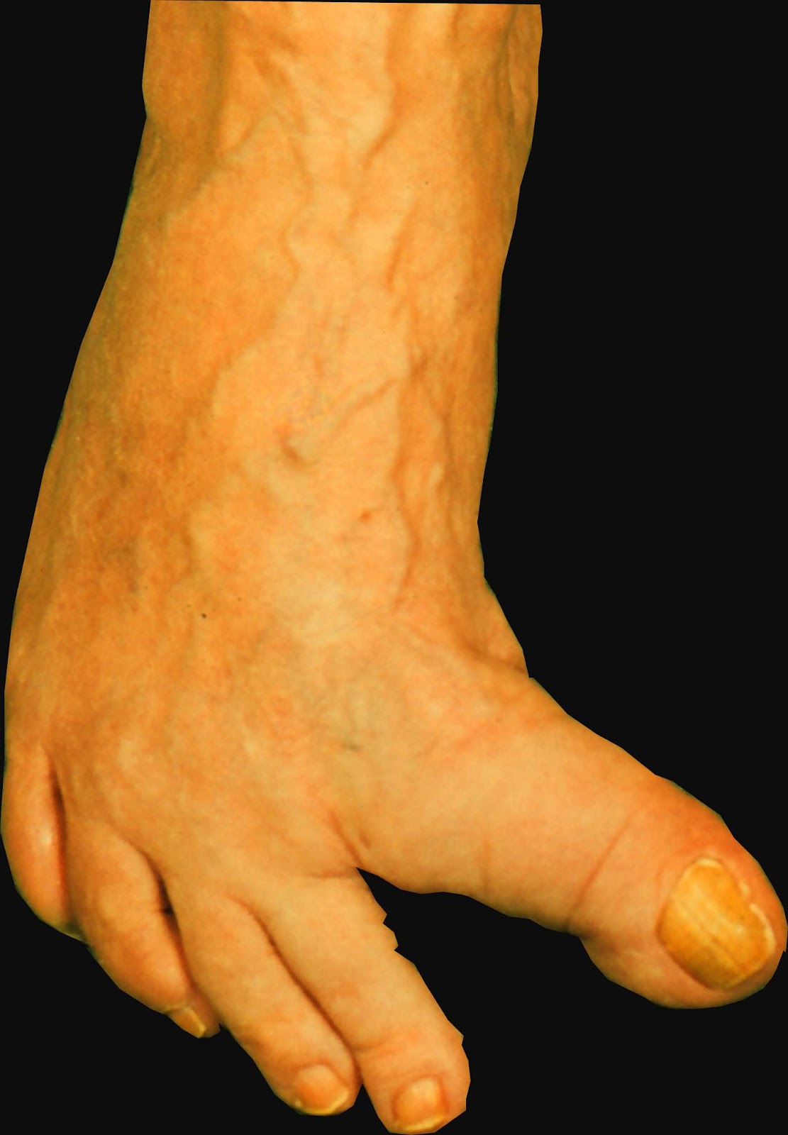 Hallux varus ~ Anatomy for MSP