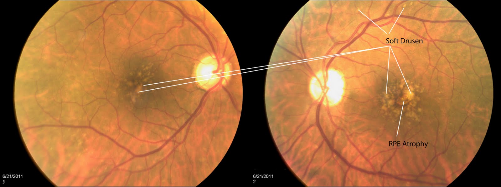 FUNdus exams: AMD, Soft Drusen and Geographic Atrophy