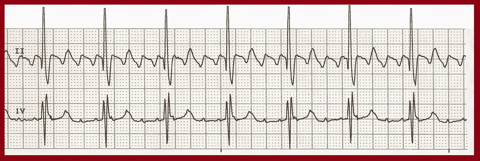 Practice Rhythm Strips 249