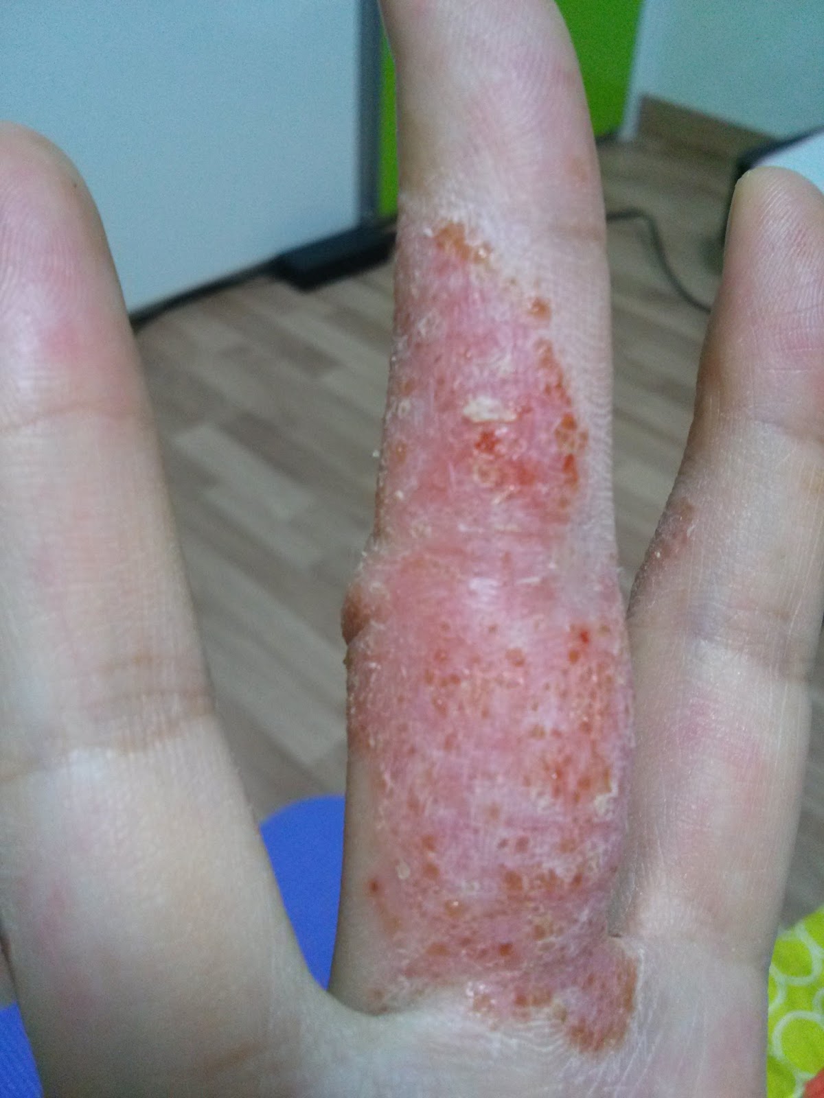 How I overcame Dyshidrosis: 한포진이 뭐에요? What is the Dyshidrosis?