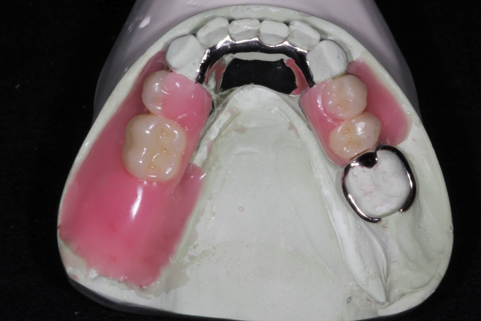 Boise Idaho Prosthodontics: Semi-Precision attachment RPD - 3 different ...