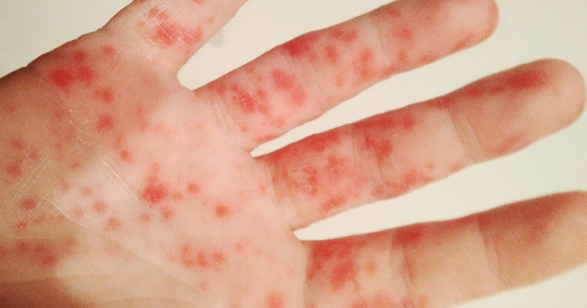 Bostonka u dorosłych - objawy, skuteczny sposób leczenia - Przypadkowe ...