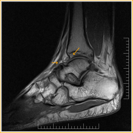 Anterior ankle impingement-MRI - Sumer's Radiology Blog