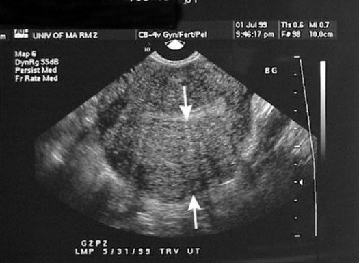 Apa Sih Penyebab Rahim Membengkak dan Membesar?