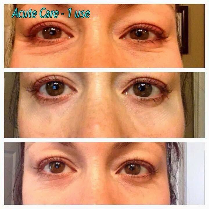 Acute Care: Acute Care For Expression Lines