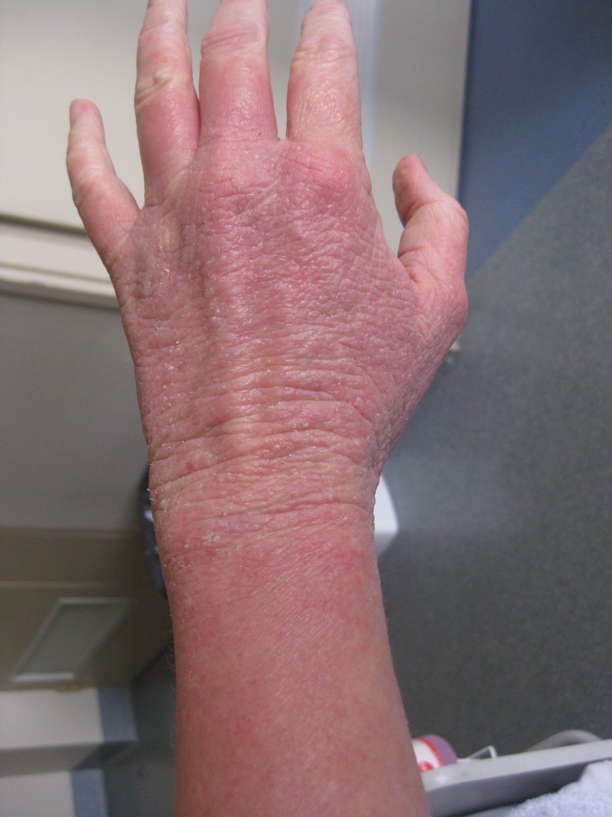 Topical Steroid Withdrawal Journey-Healing Eczema and Red Skin Syndrome ...