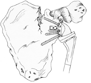 UW Shoulder and Elbow Academy: Reverse total shoulder - safe baseplate ...