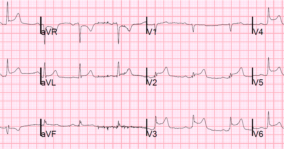 Dr. Smith's ECG Blog: Pericarditis, or Anterior STEMI? The QRS proves it.