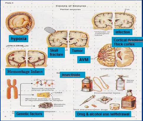 PUBLIC HEALTH: CLINICAL ASPECT OF PARTIAL EPILEPSY
