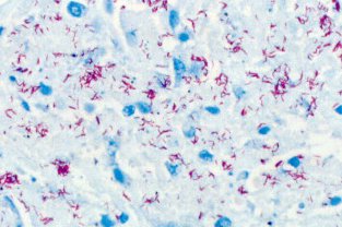 ZIEHL-NEELSEN STAIN (ZN) - Microbiology Laboratory Turkey