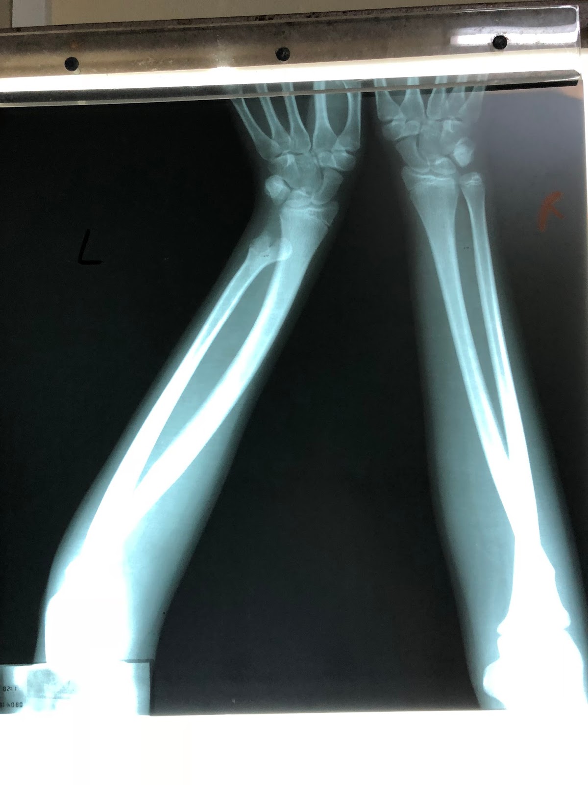 Mission Trip | Congenital Hand and Arm Differences | Washington ...