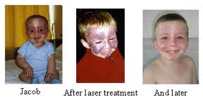 SINDROM JACOBS ~ RAGAM INFO