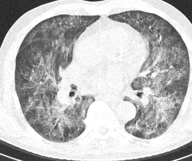 Pneumocystis Carnii-CT - Sumer's Radiology Blog