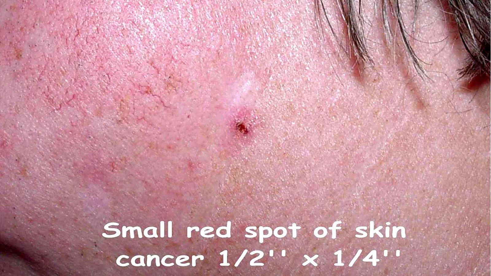 What Is The Most Dangerous Form Of Skin Cancer - Danger Choices
