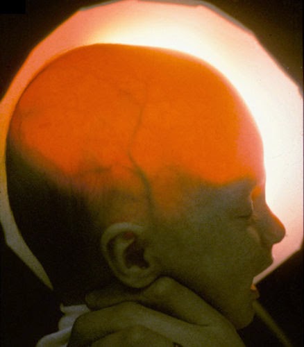 Hydranencephaly