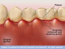 selulitis rongga mulut ~ cellulitis treatment journal
