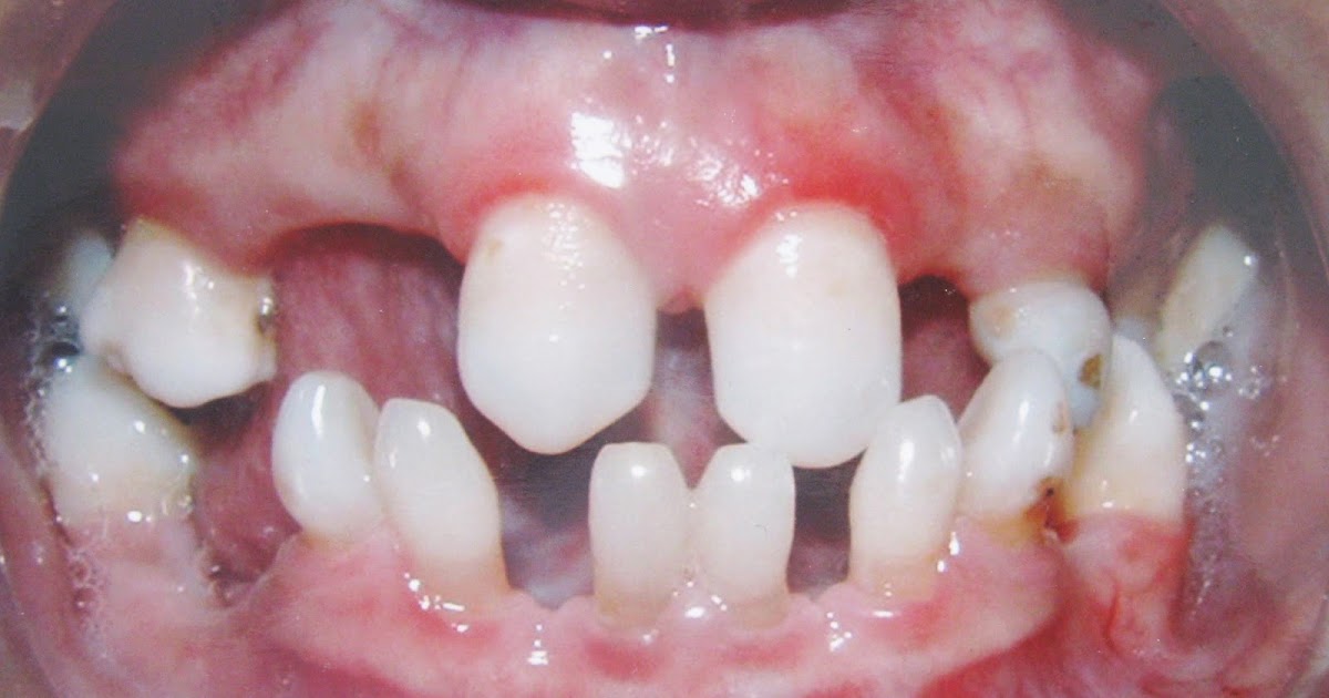 CLINICA DENTAL ASISTENCIAL: DISPLASIA ECTODÉRMICA HIPOHIDRÓTICA
