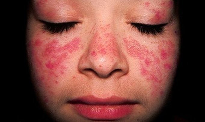 ¿Sabe que es el Lupus?, conozca 8 aspectos para saber más sobre esta ...