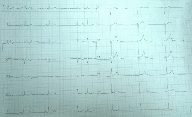 Cardiology window: ECG Sinus node dysfunction