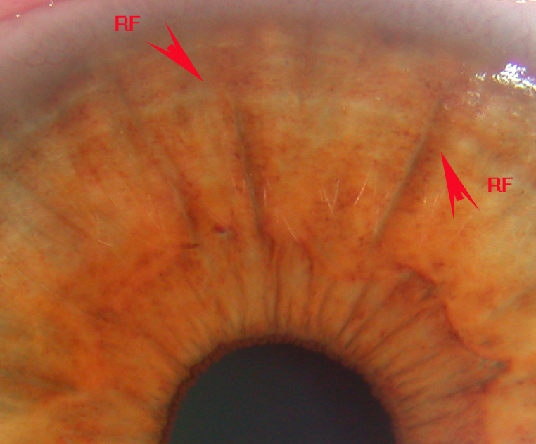 Modern & Multidimensional Iridology: Mixed Biliary Iris Constitution