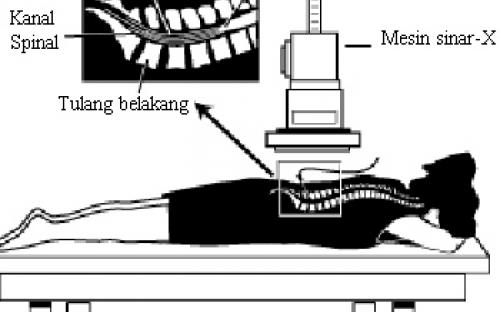 ATRO MEDAN (Iqbal Tren): Myelografi