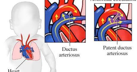 Mengenal Patent Ductus Arteriosus (PDA), Salah Satu Penyakit Jantung ...