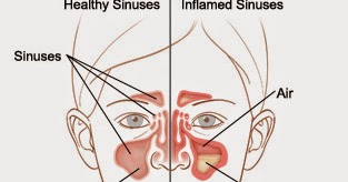 Devinisi,Penyebab,Gejala dan Cara Pengobatan Sinusitis