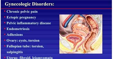 Health: 4 Common Gyn Disorders