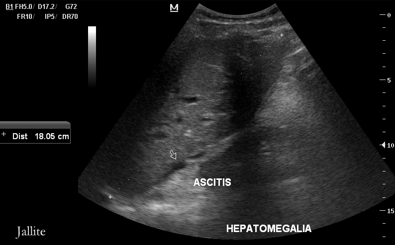 Dengue: Evaluacion Sonografica
