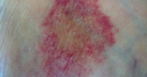 Petechial Rash in Meningitis ~ Article To Day Free