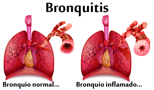 BRONQUITIS...