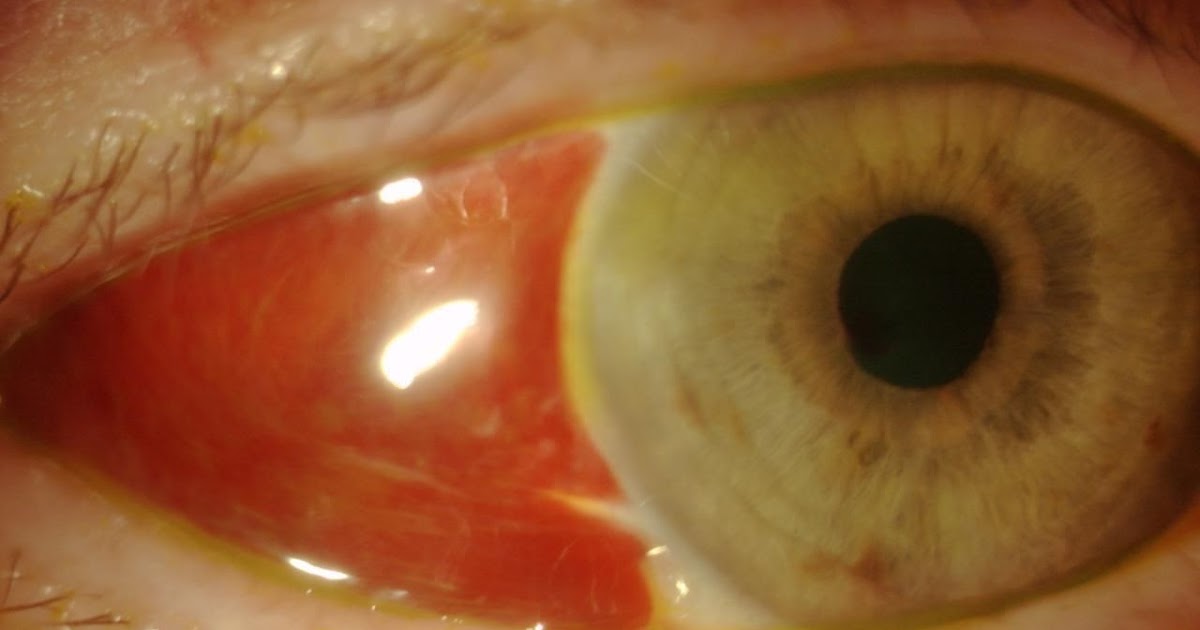 Sonoran Desert Eye Center: SUBCONJUNCTIVAL HEMORRHAGE