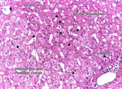 موقع الدكتور أحمد كلحى: صور باثولوجى - Pathology : Cell Injury and ...