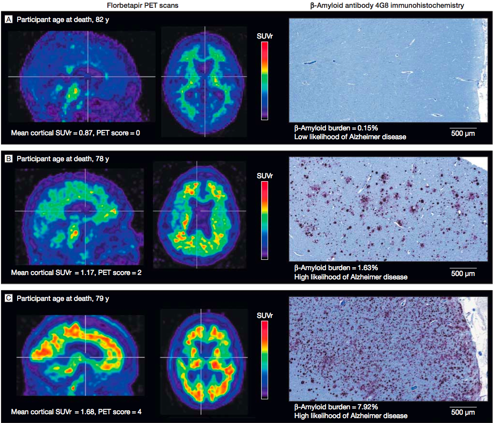 Neurology research and practice: Curing Alzheimer's Disease
