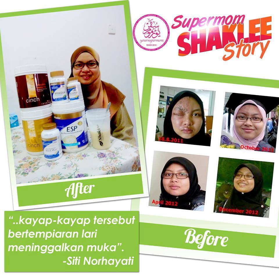 Rawatan Semulajadi Sembuhkan Kayap Sebelum Jadi Kronik - Sihat Itu Nikmat