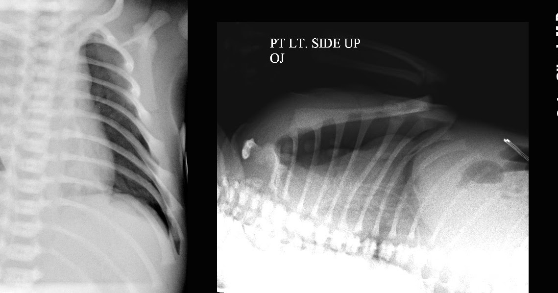 Tecnicos Radiologos: Signo del surco profundo en Neumotórax