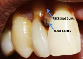 Health and Fitness: Periodontal disease and root caries