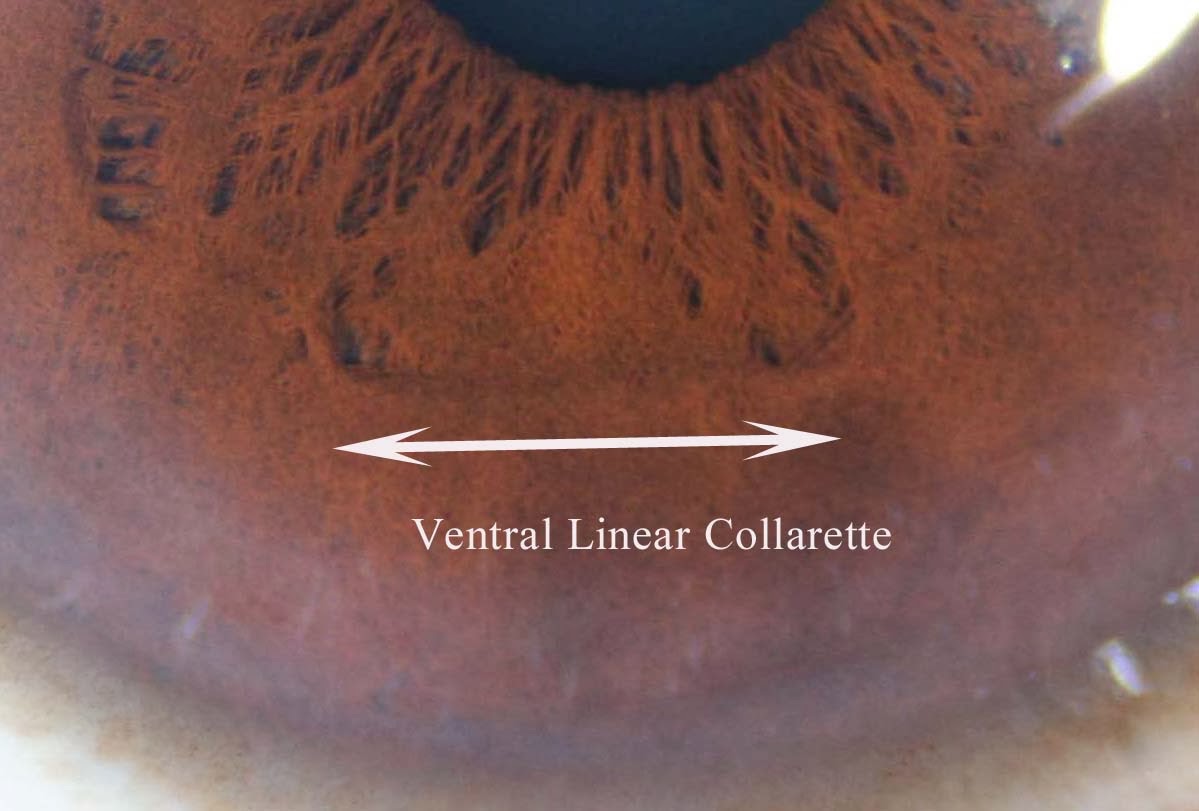 Modern & Multidimensional Iridology: Stairstep Lacuna & The Collarette ...