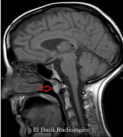 El Baúl Radiológico: QUISTE DE TORNWALDT. BURSA RINOFARÍNGEA (Tornwaldt ...