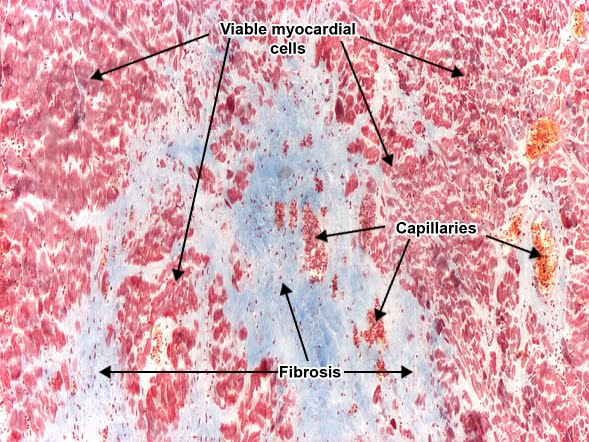 Histology And Explanation Of Ischemic Fibrosis Of Myocardium diffuse histology-and-explanation-of-ischemic-fibrosis-of-myocardium-diffuse