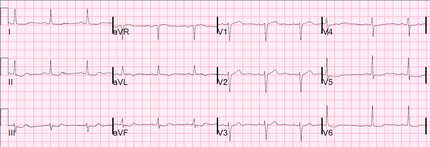 Dr. Smith's ECG Blog: Look at II, III, aVF in this case, and the ...