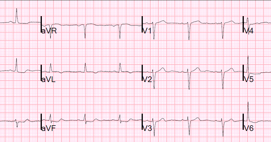 Dr. Smith's ECG Blog: Look at II, III, aVF in this case, and the ...