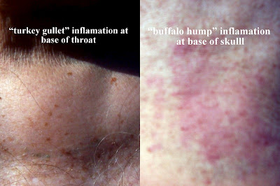 my lung cancer odyssey: buffalo hump vs turkey gullet